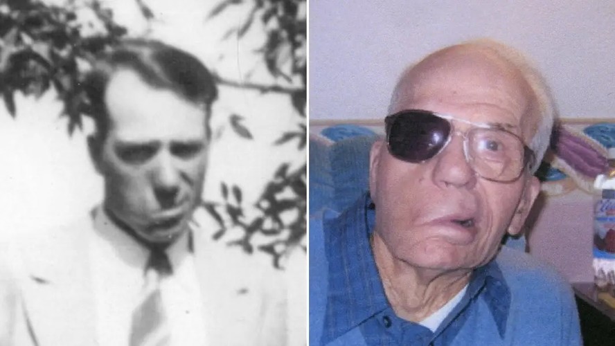Recordista viveu mais de 94 anos com bala na cabeça; conheça sua história