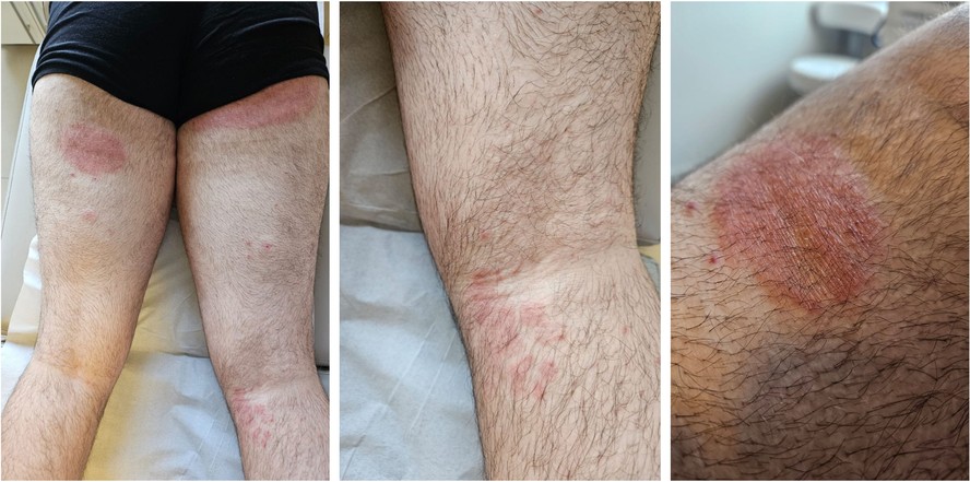 O que já se sabe sobre fungo resistente registrado pela 1ª vez no Brasil