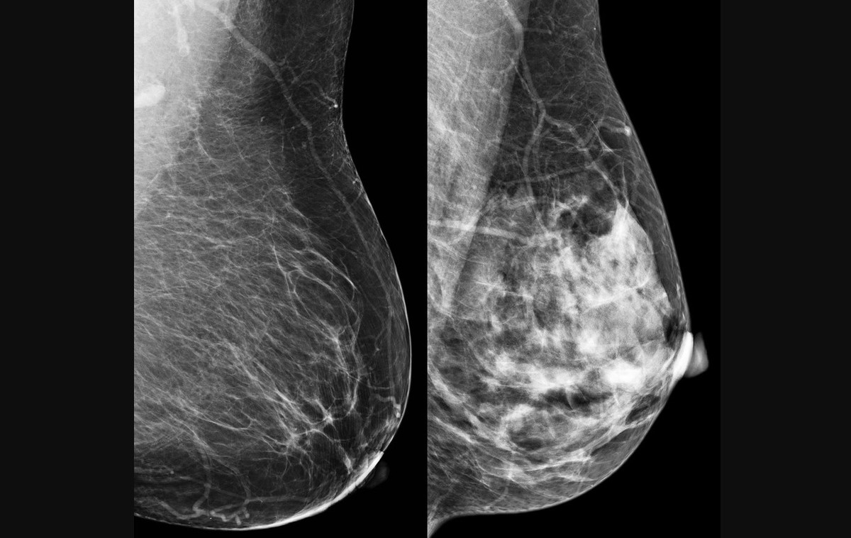 Ancestralidade é indicadora de risco para câncer de mama, mostra estudo