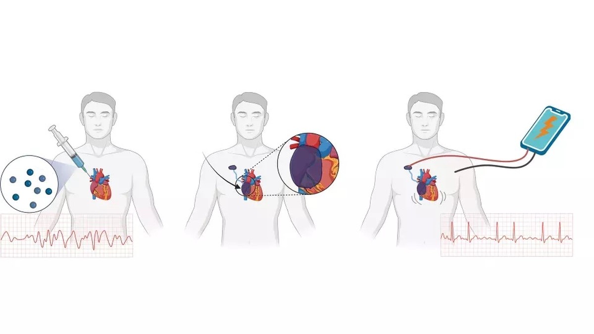 Novo marcapasso injetável some no corpo em 5 dias e funciona com celular