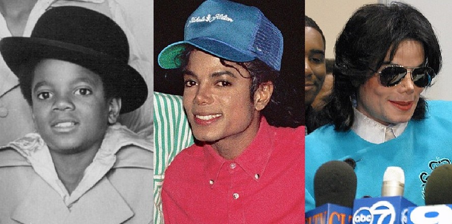 vitiligo michael jack
