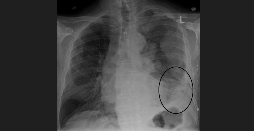 Marcador ajuda a prever a mortalidade entre pacientes com câncer ...